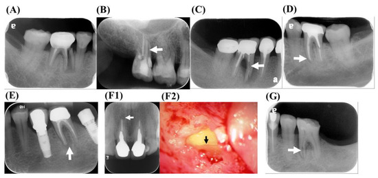 Vertical Root Fracture in Non-Endodontically and Endodontically Treated ...