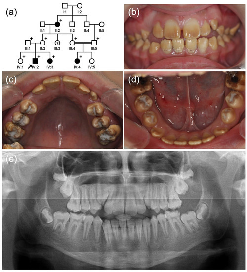 Novel Mutations in GPR68 and SLC24A4 Cause Hypomaturation Amelogenesis ...