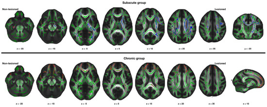 Changes in Bihemispheric Structural Connectivity Following Middle ...