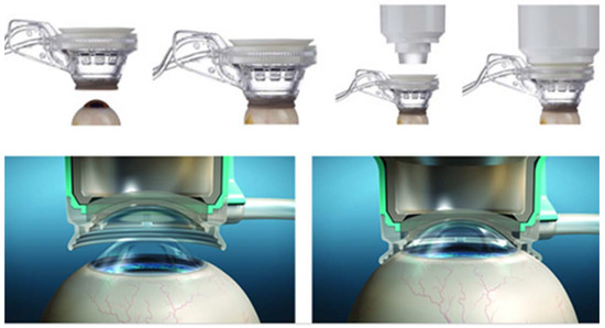 Association between Ocular Parameters and Intraocular Pressure ...