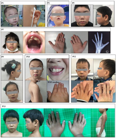 Genetic and Phenotypic Spectrum of KBG Syndrome: A Report of 13 New ...