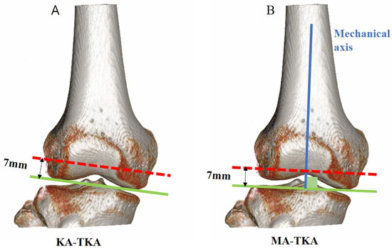 The Morphology of a Kinematically Aligned Distal Femoral Osteotomy Is ...