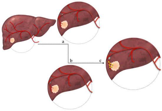 Transarterial Chemoembolization for Hepatocellular Carcinoma: Why, When ...