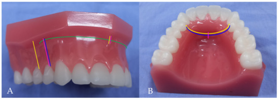 Changes in Facial Profile after Modified Anterior Maxillary Subapical Osteotomy