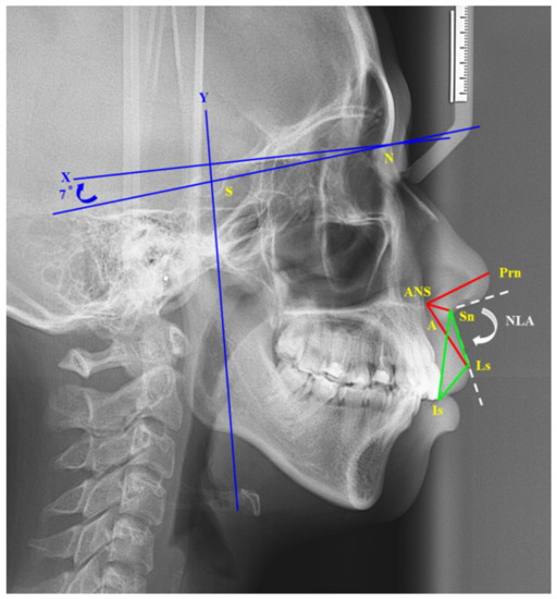 Changes in Facial Profile after Modified Anterior Maxillary Subapical ...