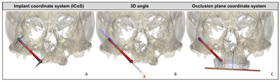 Three-Dimensional Guided Zygomatic Implant Placement after Maxillectomy