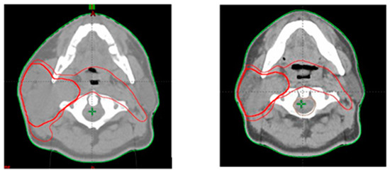 Adaptive Radiotherapy in Head and Neck Cancer Using Volumetric ...