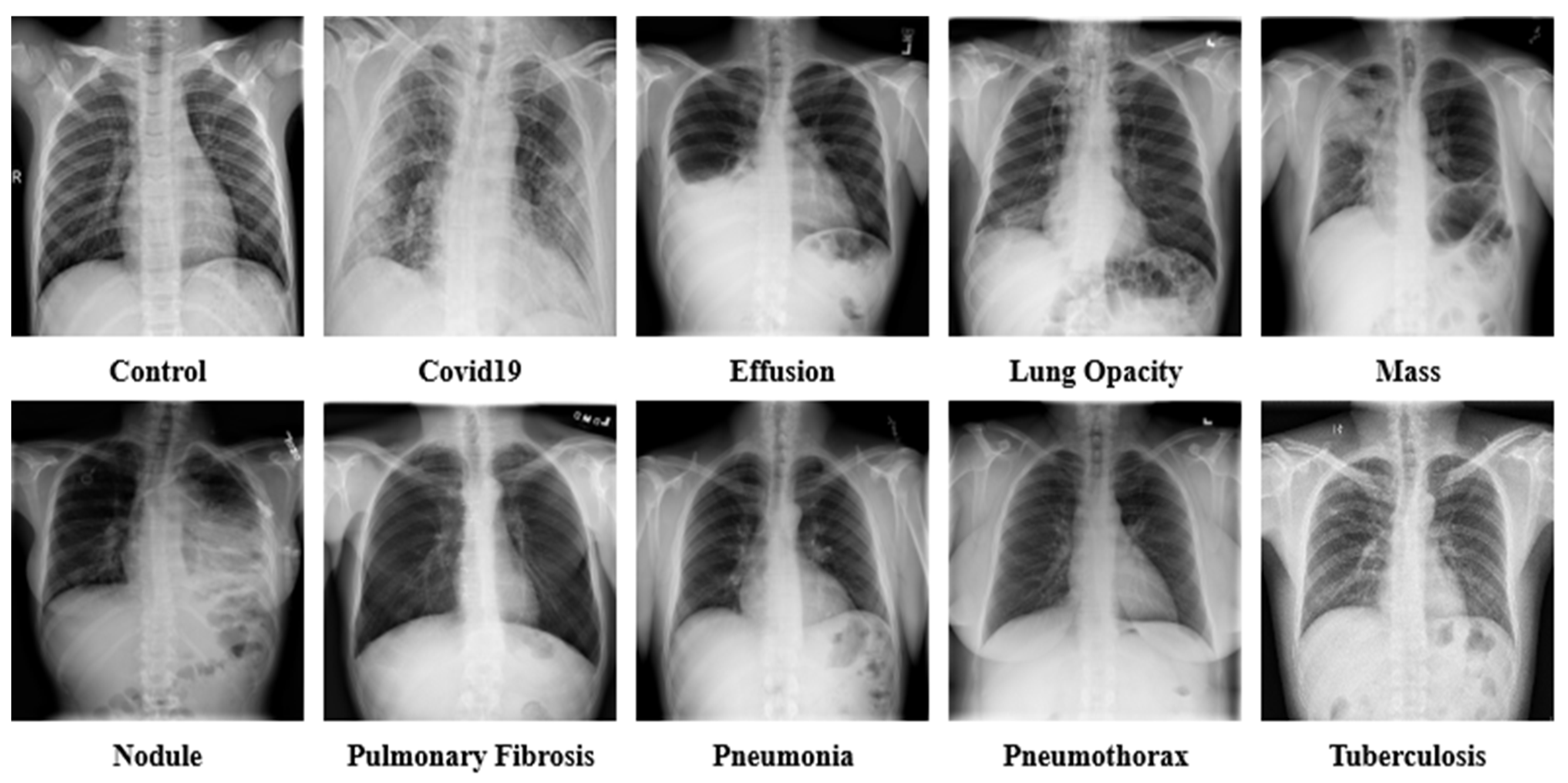 Pulmonary Fibrosis X Ray