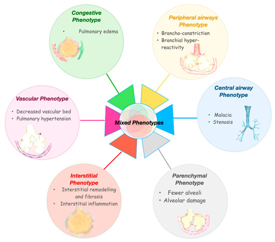 Endotypes of Prematurity and Phenotypes of Bronchopulmonary Dysplasia ...