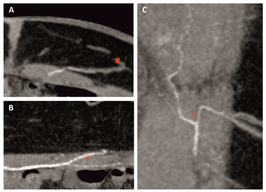 Improving the Safety of DIEP Flap Transplantation: Detailed Perforator ...