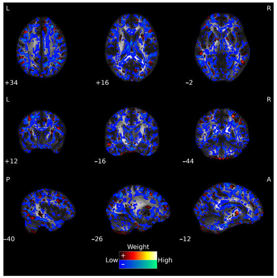 Classification of Huntington’s Disease Stage with Features Derived from ...