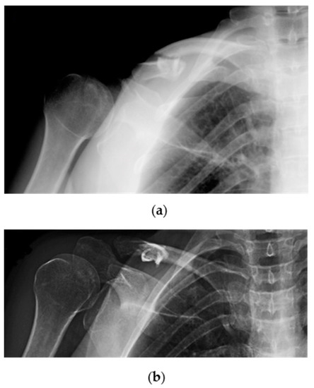 Management of Displaced Midshaft Clavicle Fractures with Figure-of ...