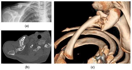 Management of Displaced Midshaft Clavicle Fractures with Figure-of ...