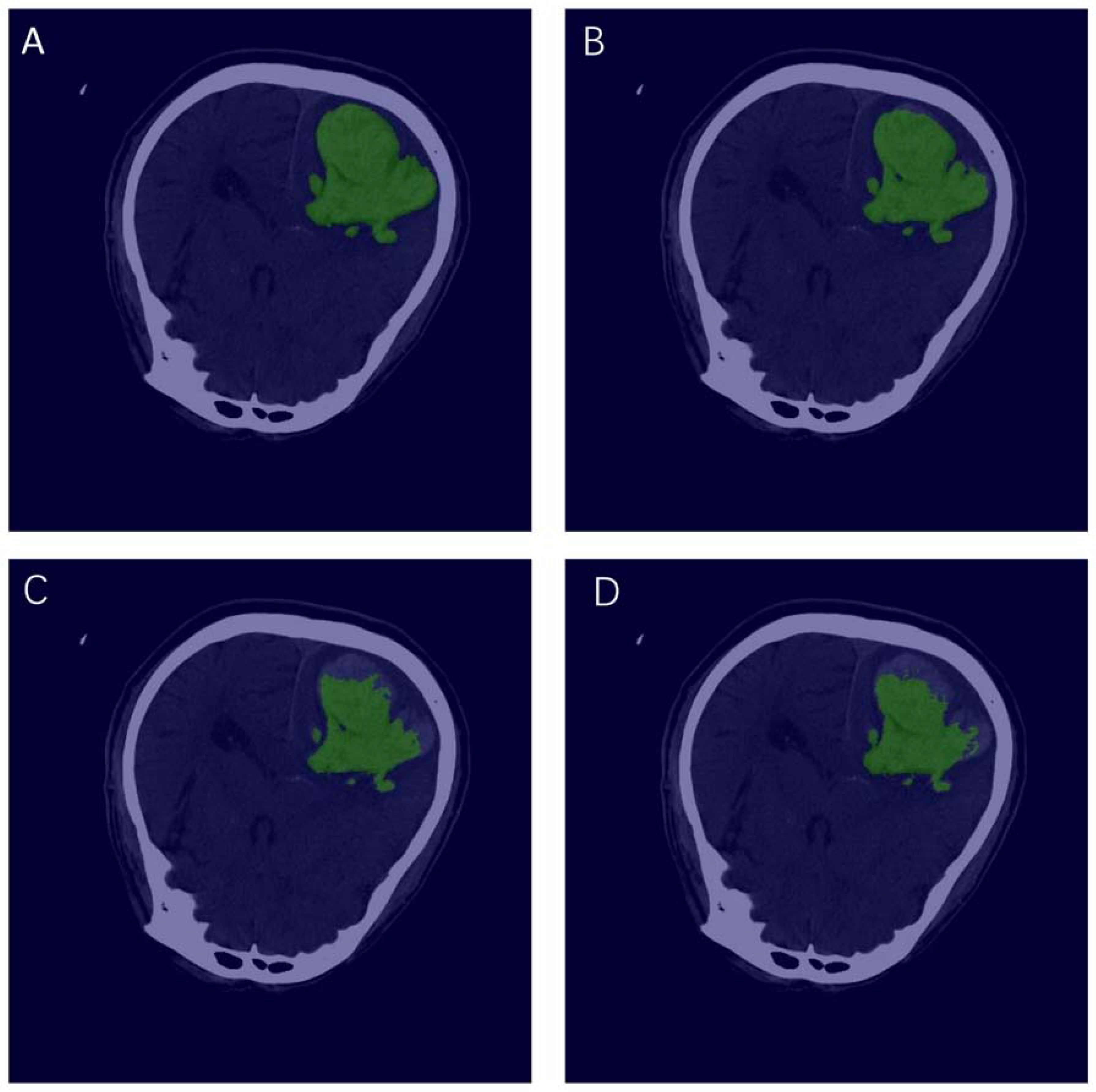 Automatic and Efficient Prediction of Hematoma Expansion in Patients with Hypertensive ...