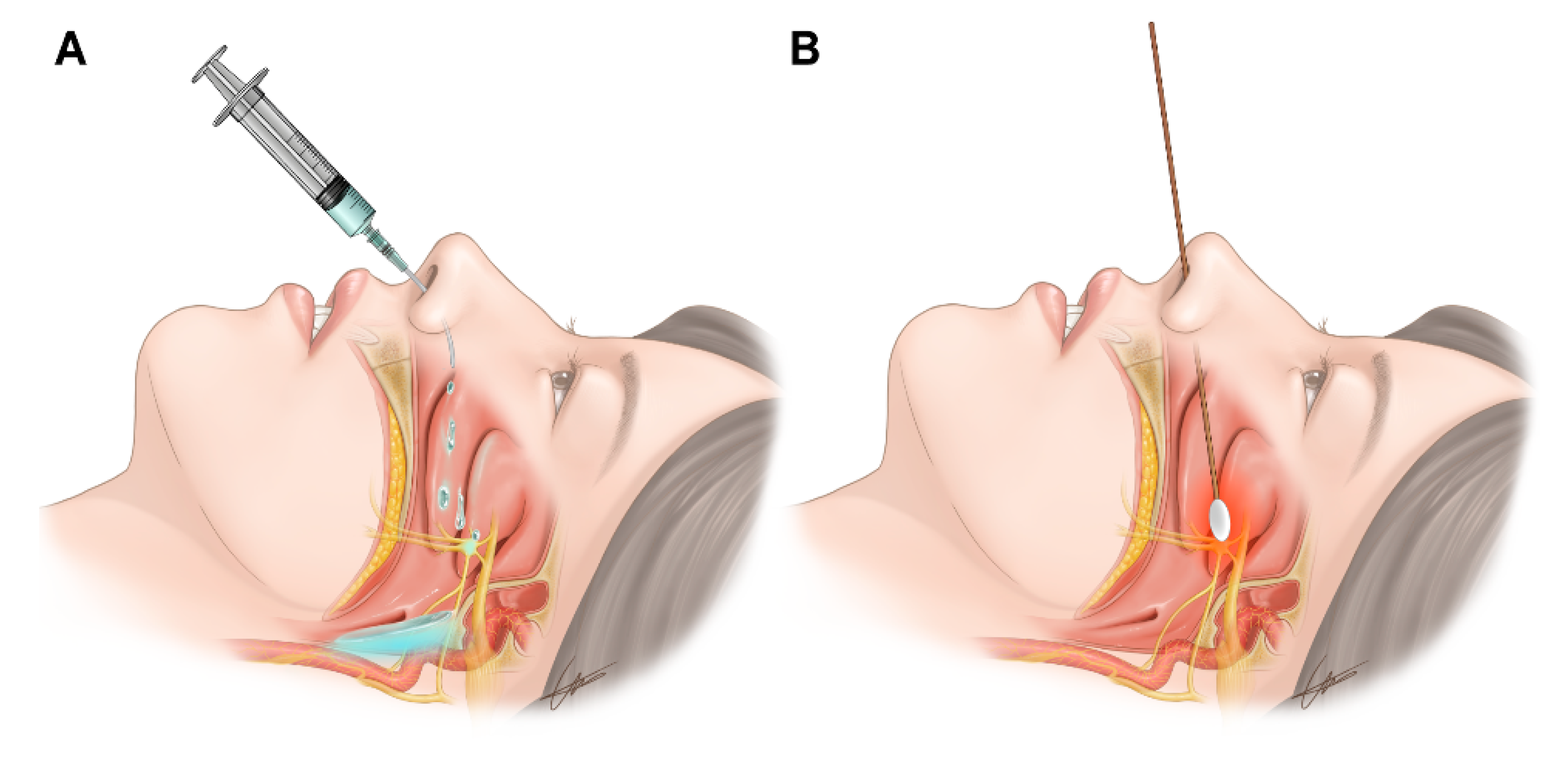 Sphenopalatine Ganglion Block For Migraine