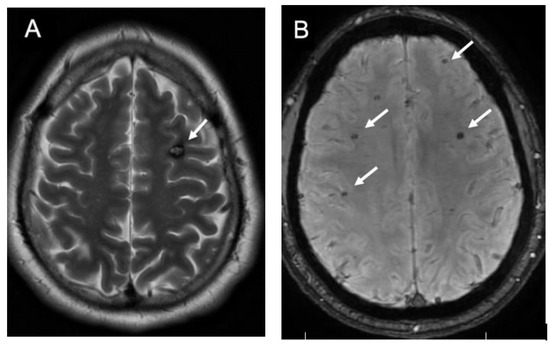 Tailored Treatment Options for Cerebral Cavernous Malformations