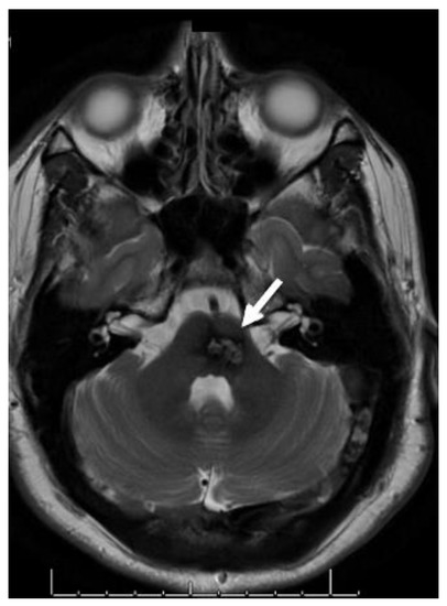 Tailored Treatment Options for Cerebral Cavernous Malformations