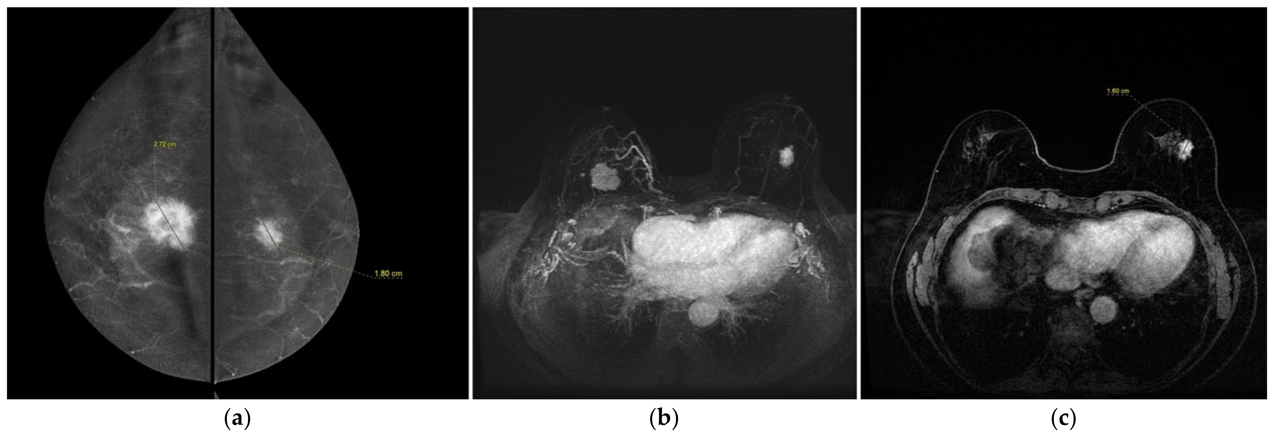 Diagnostic Challenge of Invasive Lobular Carcinoma of the Breast: What ...