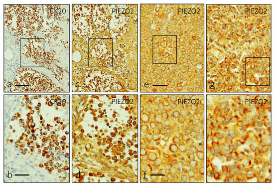 Merkel Cell Carcinoma Display PIEZO2 Immunoreactivity