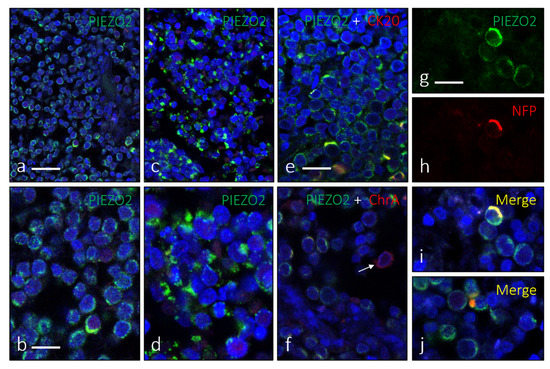 Merkel Cell Carcinoma Display PIEZO2 Immunoreactivity