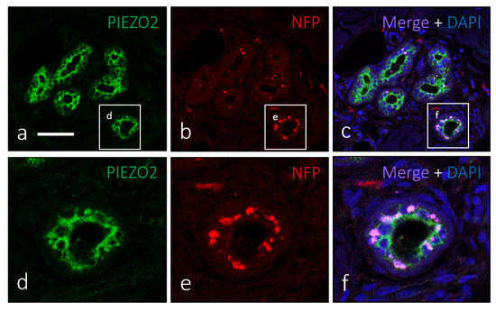 Merkel Cell Carcinoma Display PIEZO2 Immunoreactivity