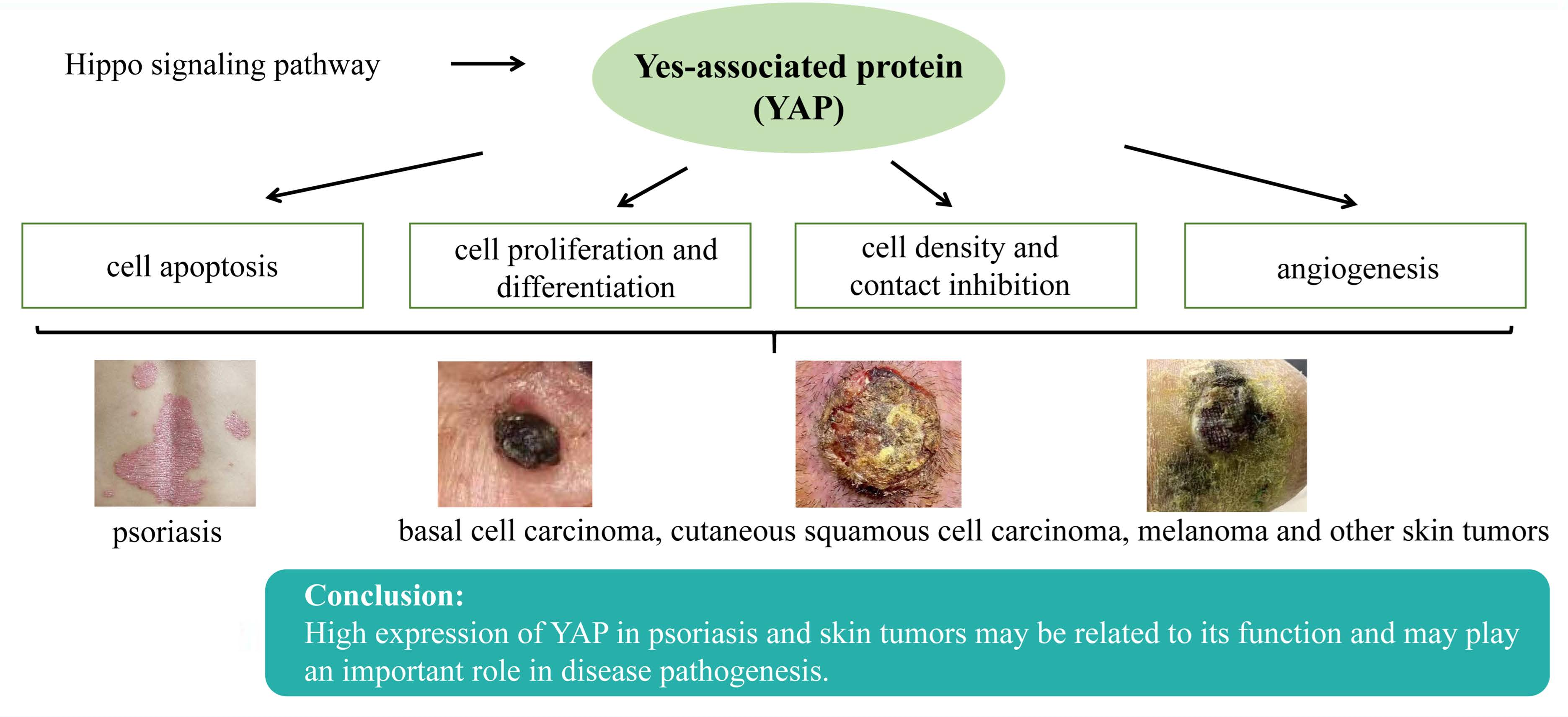 JPM | Free Full-Text | Role of Yes-Associated Protein in Psoriasis and ...