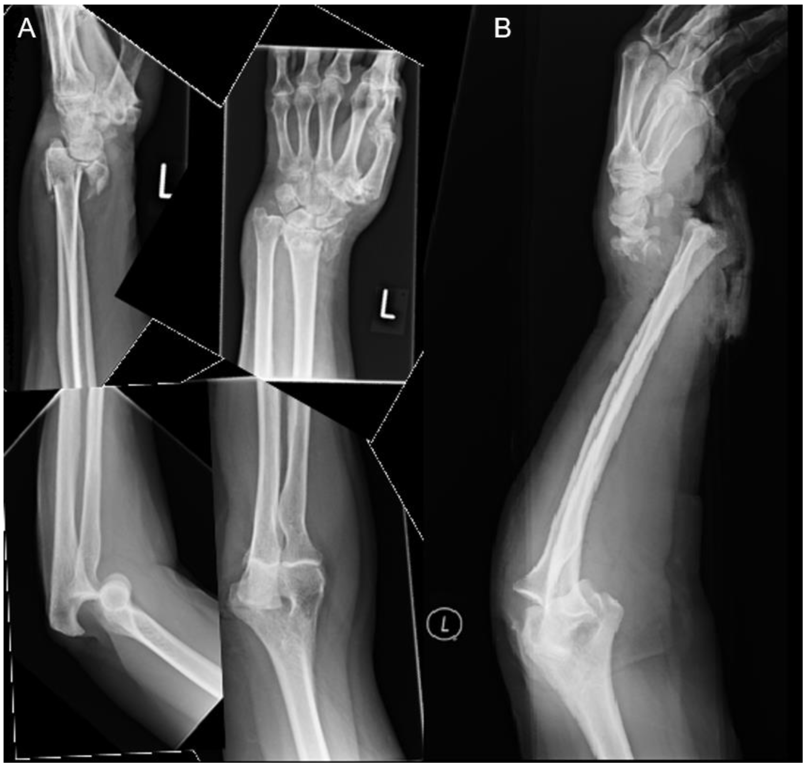 Posterior Elbow Dislocation