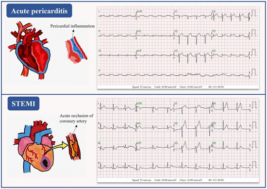 A Deep Learning Algorithm for Detecting Acute Pericarditis by ...
