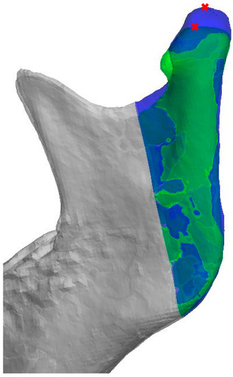 Reproducibility of 2D and 3D Ramus Height Measurements in Facial Asymmetry