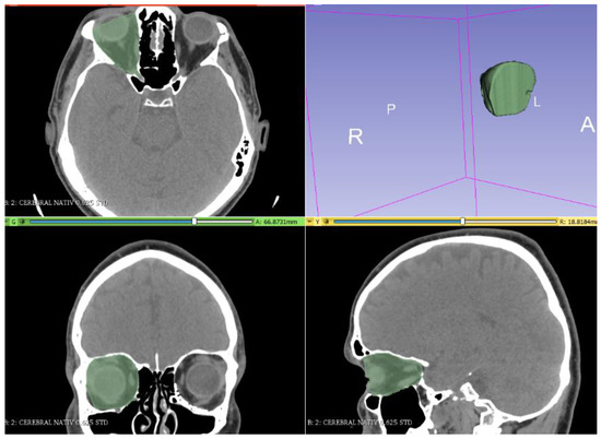 Prospective Evaluation of Intraorbital Soft Tissue Atrophy after ...