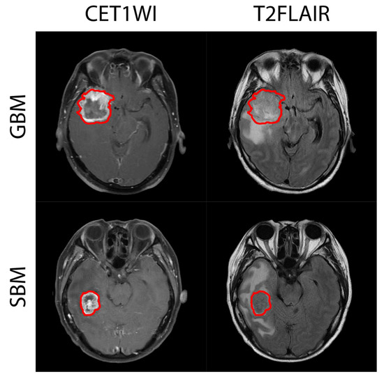 The Application of DTCWT on MRI-Derived Radiomics for Differentiation of Glioblastoma and ...