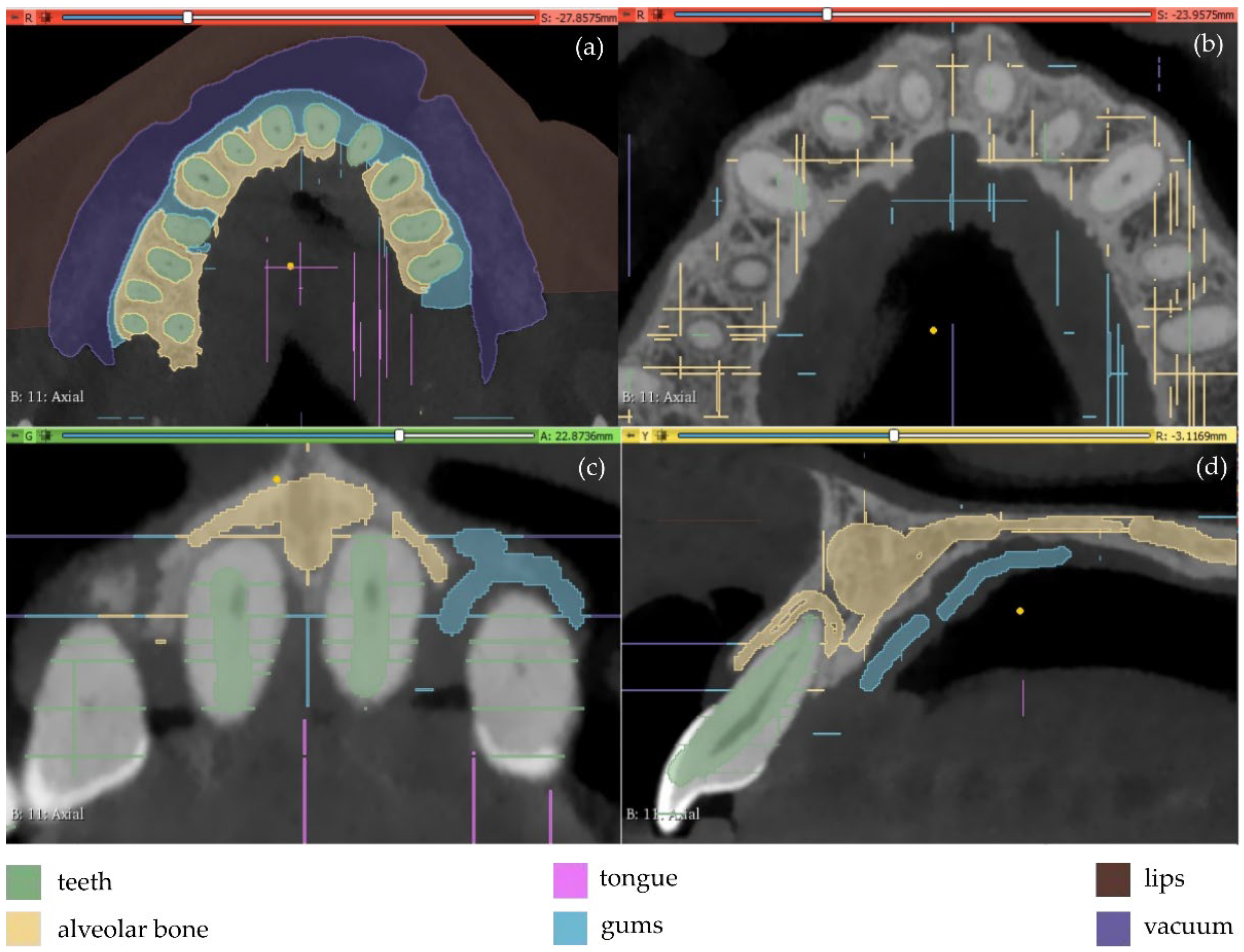 JPM | Free Full-Text | Evaluation of 3D Modeling Workflows Using Dental CBCT Data for ...