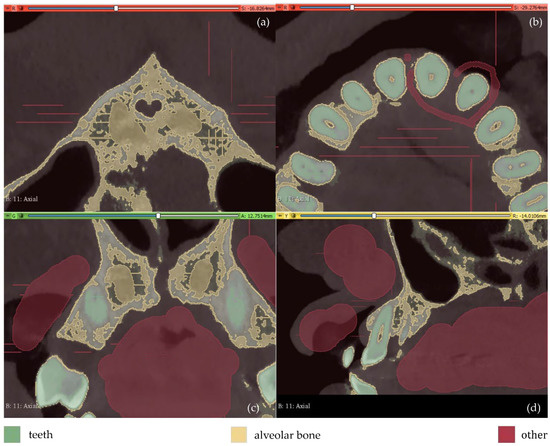 JPM | Free Full-Text | Evaluation of 3D Modeling Workflows Using Dental ...