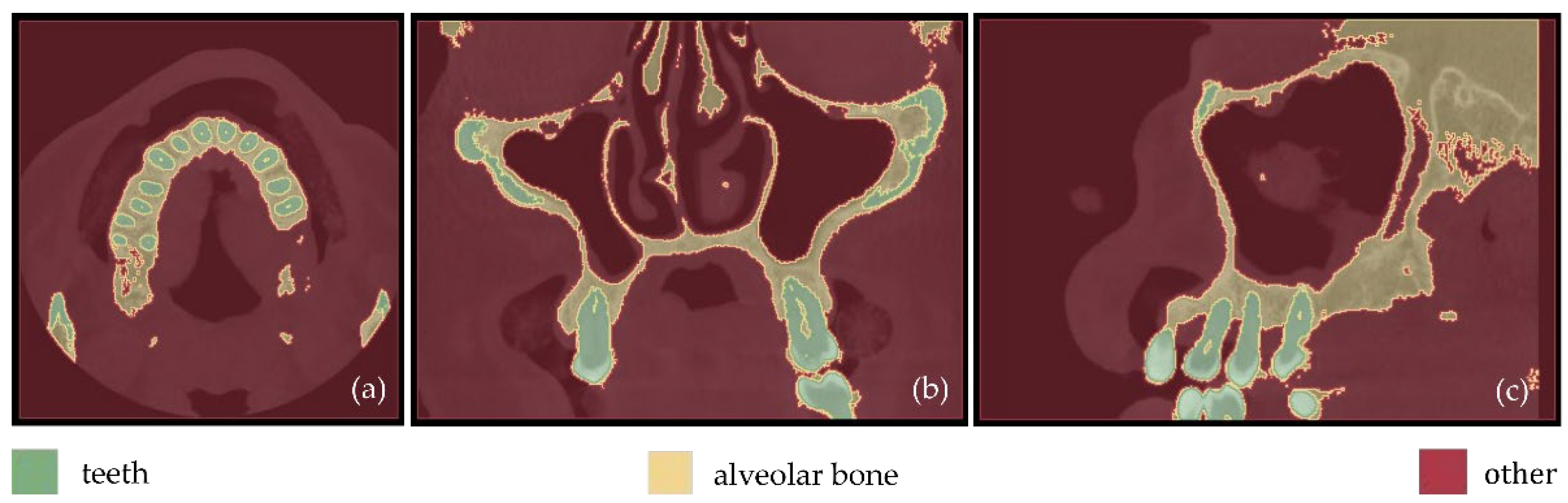 Evaluation of 3D Modeling Workflows Using Dental CBCT Data for ...