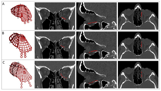 Personalized Medicine Workflow in Post-Traumatic Orbital Reconstruction