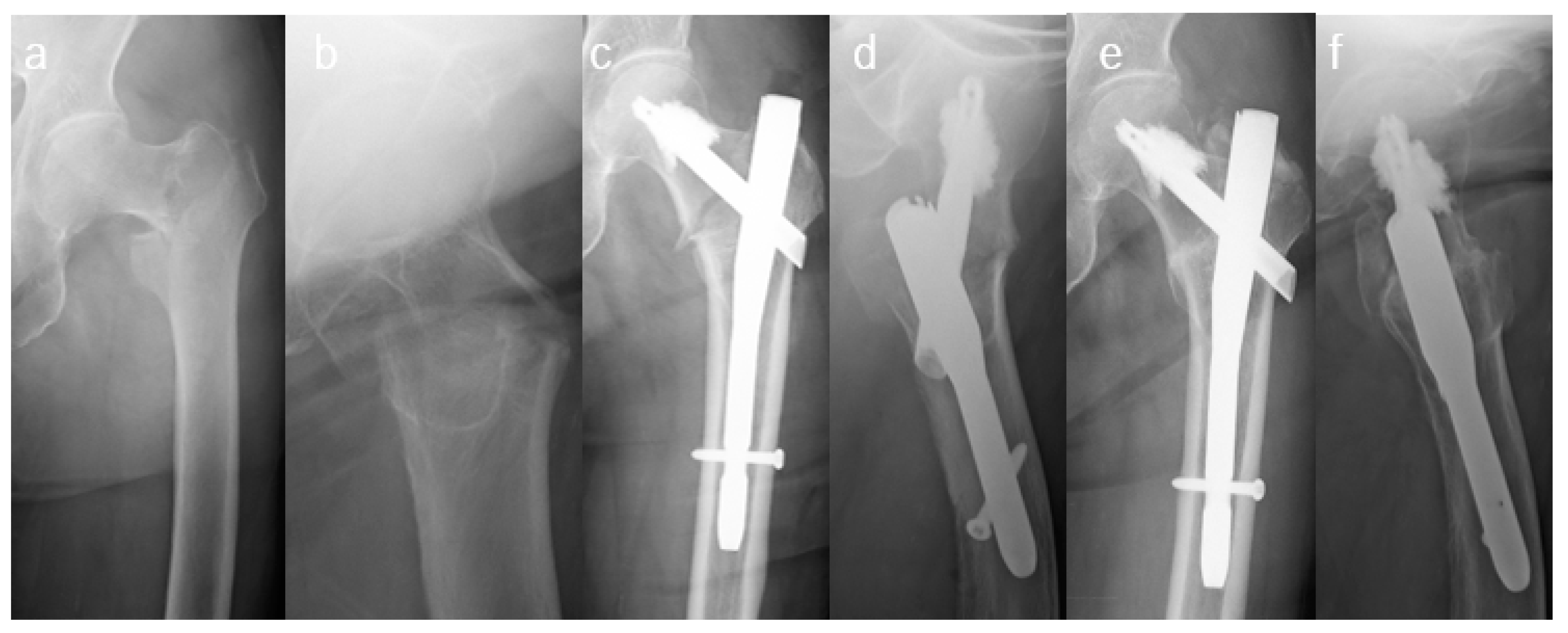 JPM | Free Full-Text | Effectiveness of Cement Augmentation on Early Postoperative Mobility in ...