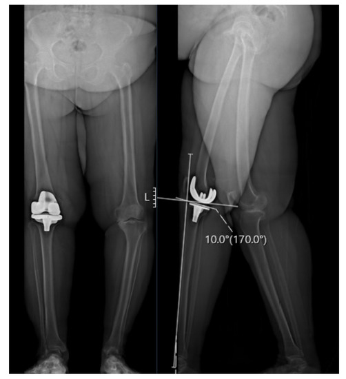 Excessive Sagittal Slope of the Tibia Component during Kinematic ...