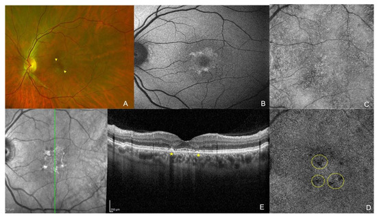 Choriocapillaris Flow Deficits Quantification in Hydroxychloroquine ...