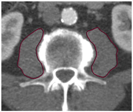 JPM | Free Full-Text | CT-Diagnosed Sarcopenia and Cardiovascular ...
