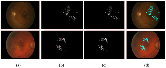 Three-Dimensional Semantic Segmentation of Diabetic Retinopathy Lesions ...