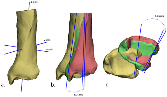 A Two-Step Approach for 3D-Guided Patient-Specific Corrective Limb Osteotomies