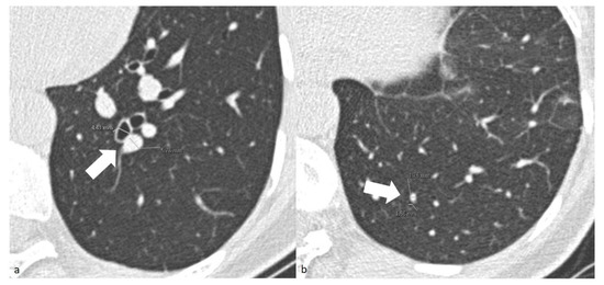 The Caliber of Segmental and Subsegmental Vessels in COVID-19 Pneumonia ...