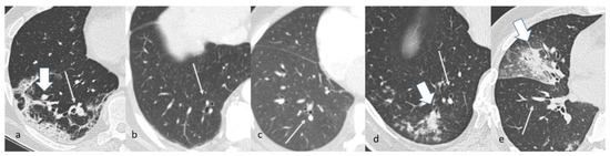 The Caliber of Segmental and Subsegmental Vessels in COVID-19 Pneumonia ...