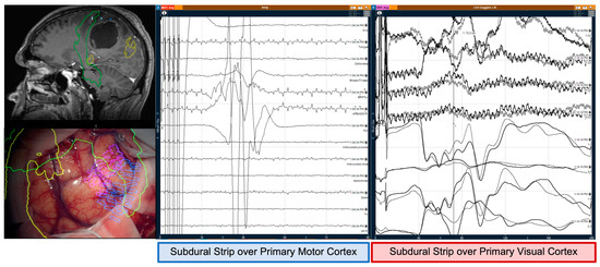 JPM | Free Full-Text | Simultaneous Motor and Visual Intraoperative ...