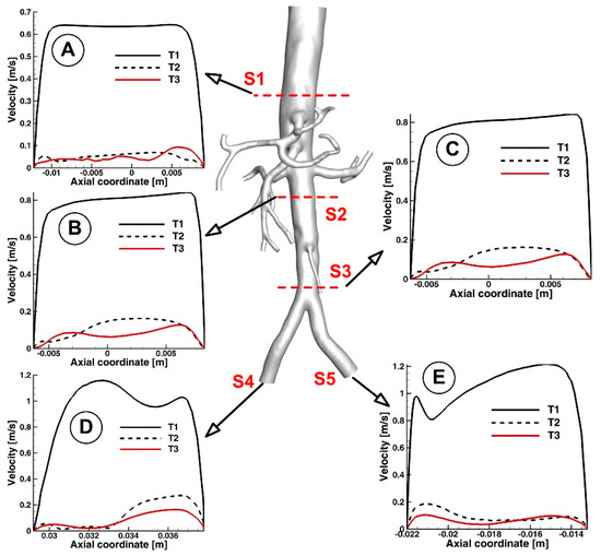 Patient-Specific Image-Based Computational Fluid Dynamics Analysis of ...