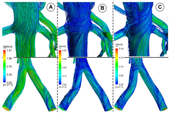 Patient-Specific Image-Based Computational Fluid Dynamics Analysis of ...