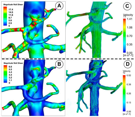 Patient-Specific Image-Based Computational Fluid Dynamics Analysis of ...