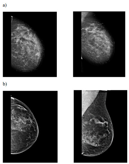 Inferior Pedicle Reduction Mammoplasty as Corrective Surgery after ...