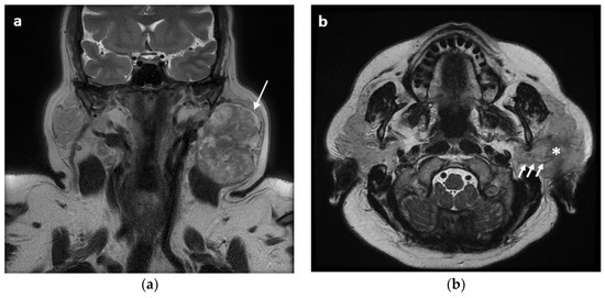 Minimal Margin Surgery and Intraoperative Neuromonitoring in Benign ...