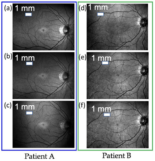 Design of a Functional Eye Dressing for Treatment of the Vitreous Floater